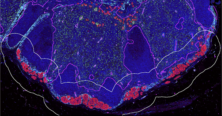 New AI deep learning tool detects changes in blood vessels in cancer ...
