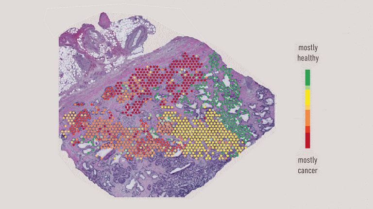 Spatial transcriptomics reveals cancer in seemingly benign tissue - SciLifeLab